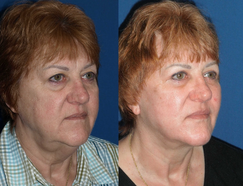 Facelift Before and After Photos San Diego