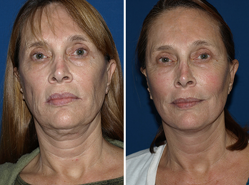 Fat Transfer Breast Augmentation Before After Cosmetic