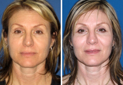 Mid Facelift Before and After Photos San Diego | David & Rossi Cosmetic ...