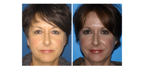 Eyelid Surgery San Diego | Eyelid Surgery