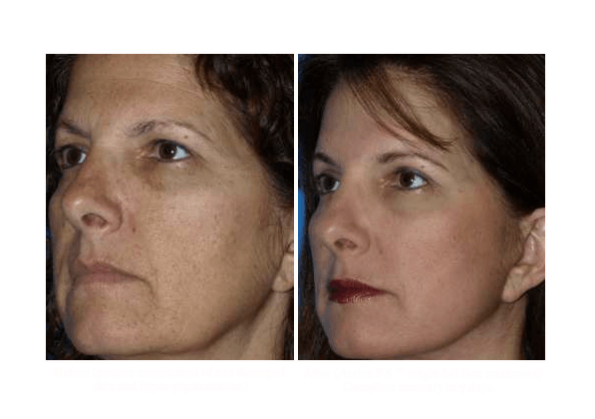 Laser Skin Resurfacing San Diego | Skin Resurfacing San Diego