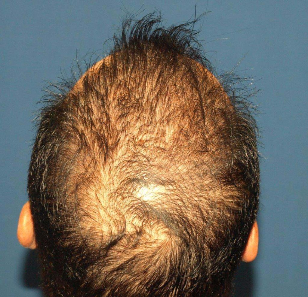 Patient 4 - Golden Triangle Plastic Surgery