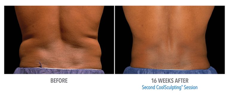 Flanks 1 | Roy David MD Plastic Surgery And Medical Spa